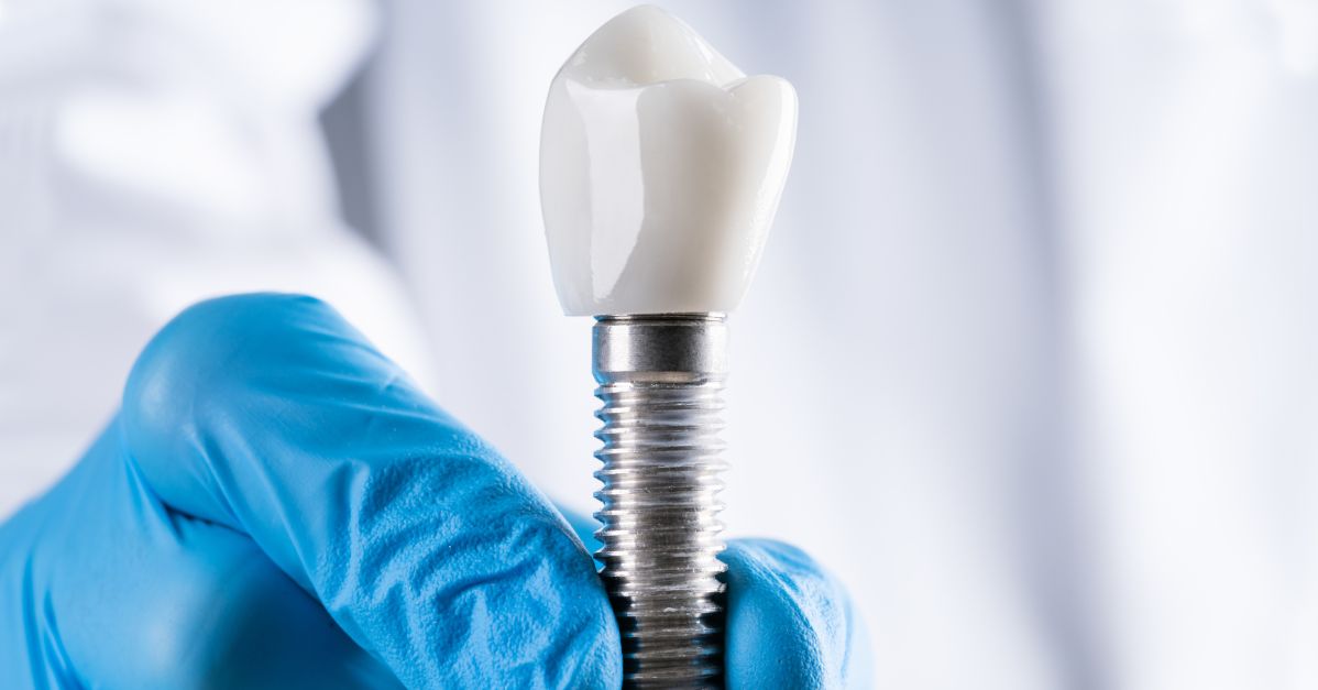 Everything You Need to Know About a Single Tooth Implant - Family ...