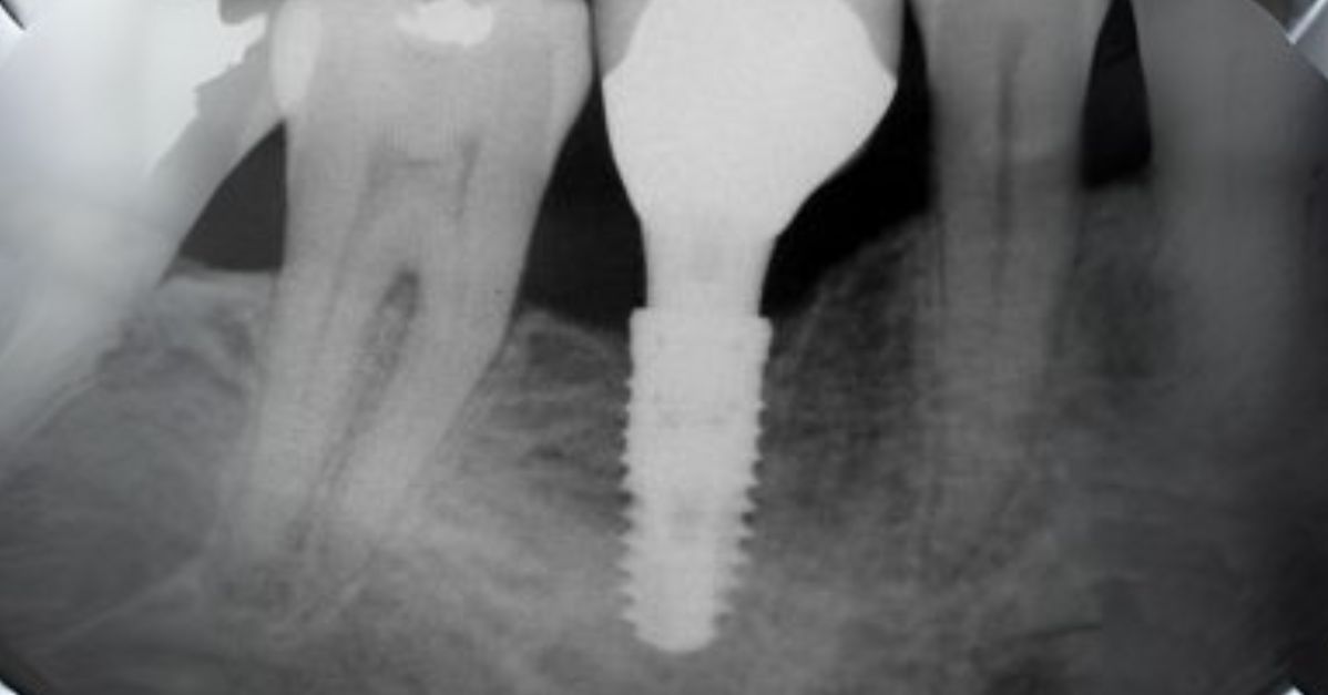 Everything You Need to Know About a Single Tooth Implant - Family ...